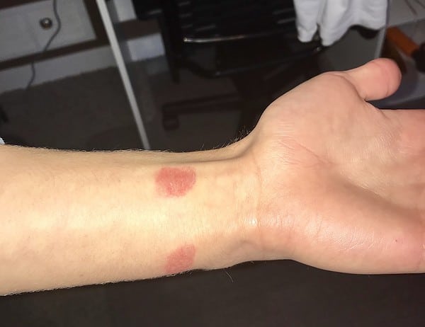 Here’s Why Your Apple Watch Is Leaving Burn Marks on Your Wrist - The ...